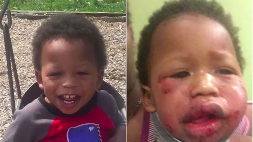 Mom furious after 1-year-old baby suffers horrendous facial injuries at ...