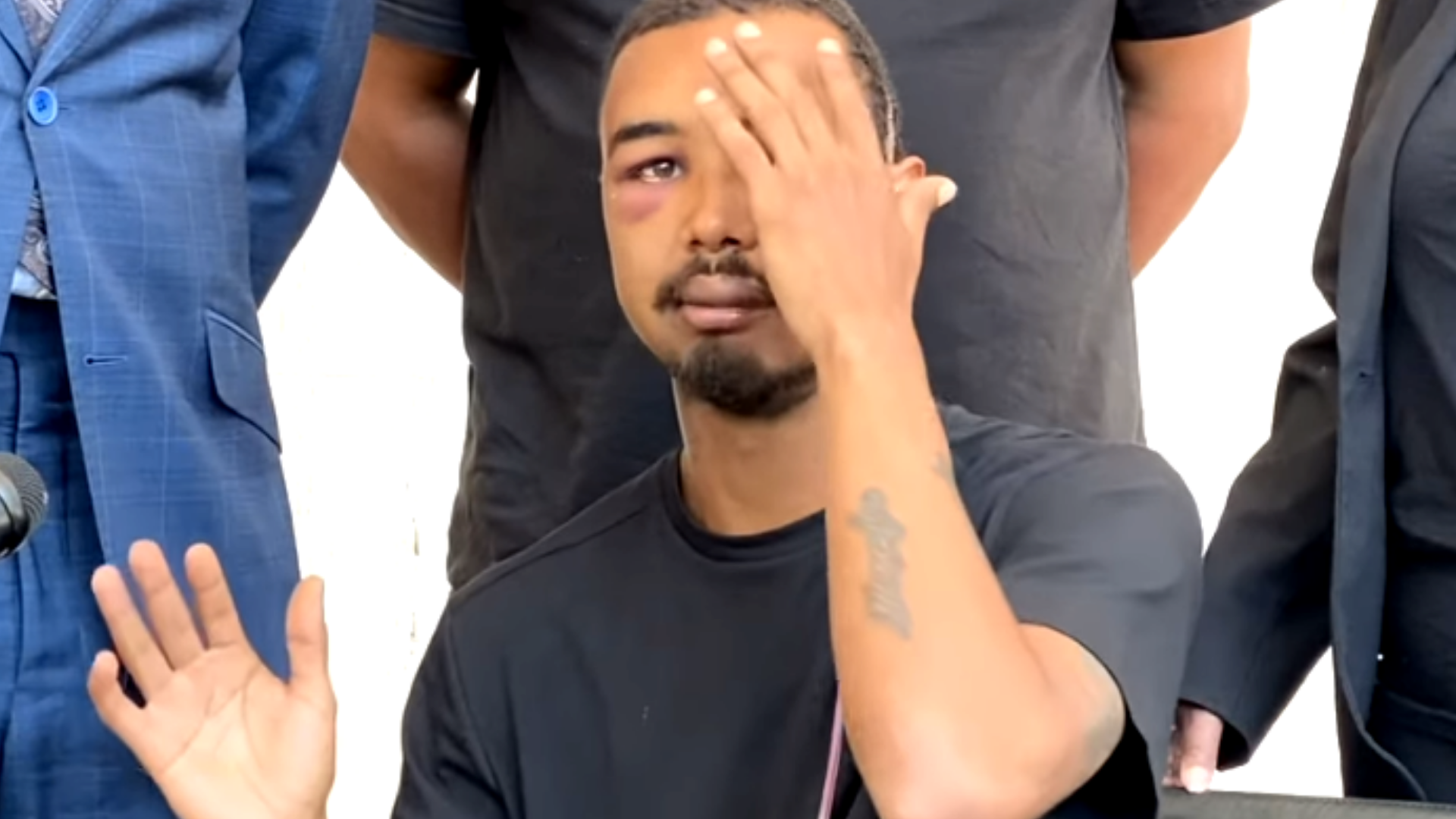 Dallas protester loses eye, teeth after police shoot him